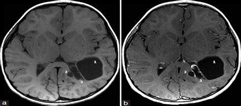 Journal Of Pediatric Neurosciences