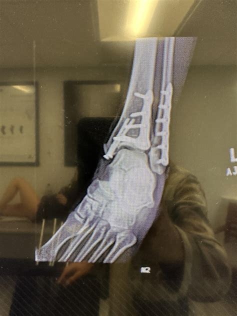 Bad Broken Ankle Shattered Trimal W Dislocation Looking For Success Stories Or Similar