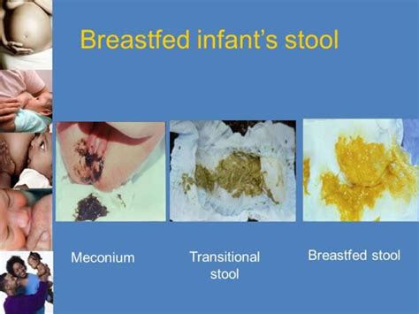 Breastfeeding Stool Chart At Elaine Leak Blog