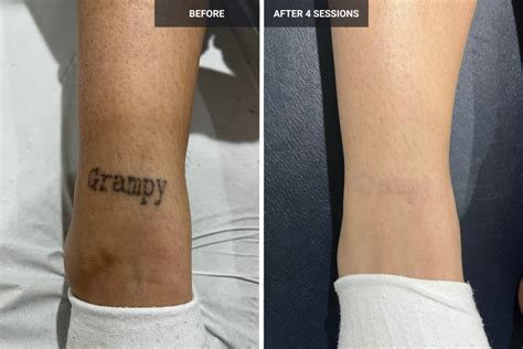 Laser Tattoo Removal Before And After