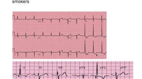Lvh Rvh Left Ventricular And Right Ventricular Hypertrophy Ekg Criteria Youtube