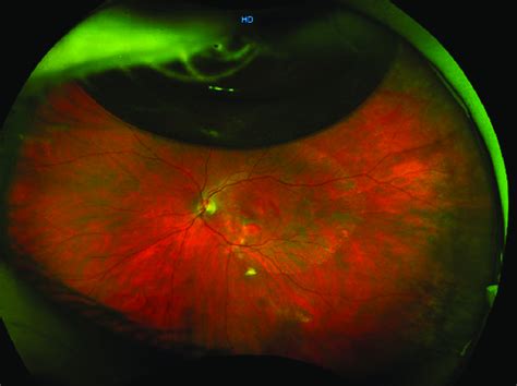 Color Fundus Photo Taken At Postoperative Week Two Demonstrating