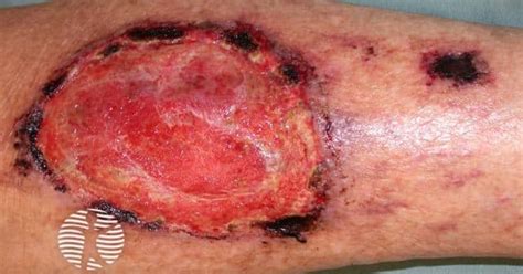 Pyoderma Gangrenosum Image