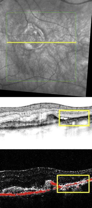 Comparison Of Polarization Sensitive Optical Coherence Tomography And Download Scientific