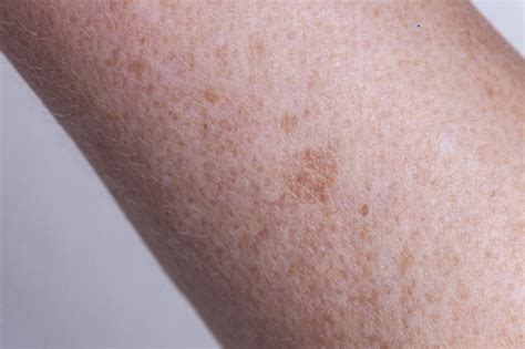 How Red Light Therapy Can Treat Hyperpigmentation