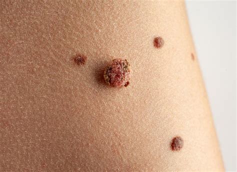 Superficial Spreading Melanoma