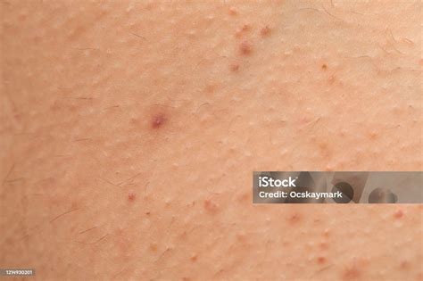 Folikulitis Pada Kulit Ketidakseimbangan Hormon Foto Stok Unduh Gambar Sekarang Cukur