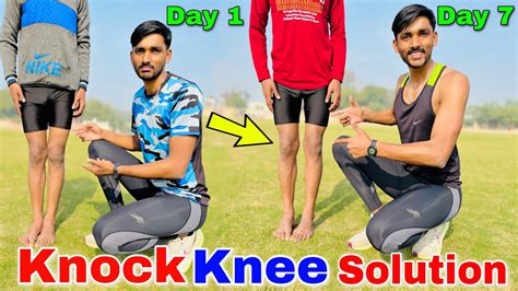 Knock Knee कैसे ठीक करें Knock Knee Problem Solution Knock Knees Best Exercise And Tips In