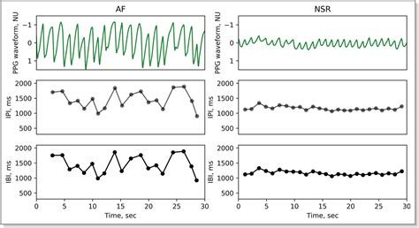 Table 1 From Atrial Fibrillation Detection Using A Novel Cardiac Ambulatory Monitor Based On