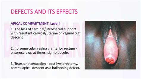 Pelvic Organ Prolapse Pptx