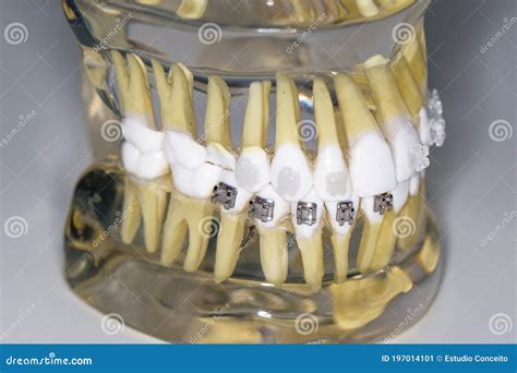 Orthodontic Model And Dentist S Tool Demonstration Teeth Model Rests On The Teeth In An