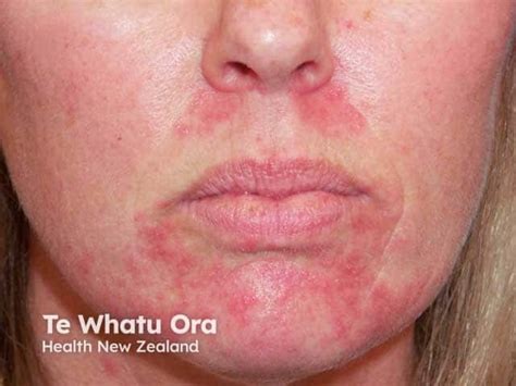 Perioral Dermatitis Symptoms Treatment And Pictures