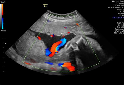 Velamentous Cord Insertion Ultrasound