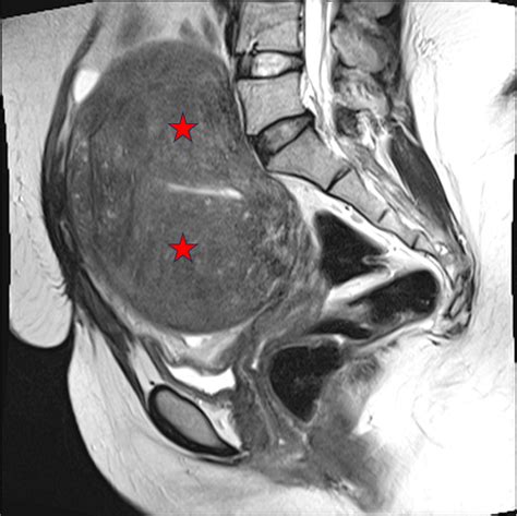Diagnosis Of Adenomyosis Adenomyosis How To Diagnose