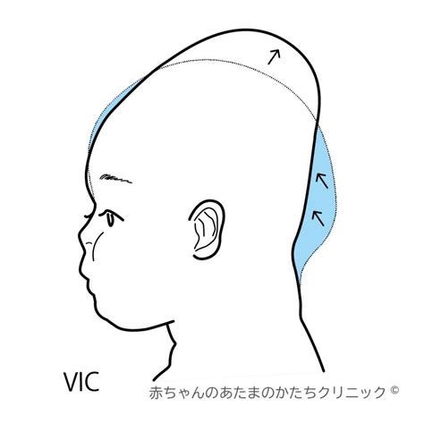 短頭 症 絶壁 赤ちゃんの頭の形クリニック港区赤坂