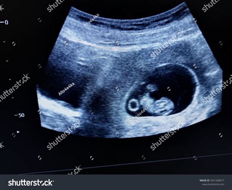 Amnion Ultrasound