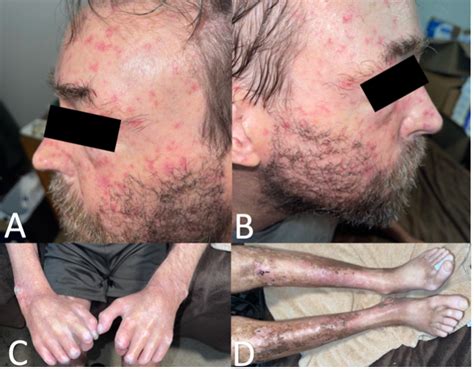 Seronegative Atypical Diffuse Systemic Sclerosis Consultant360