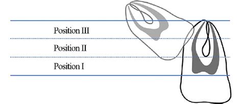 Tooth Position Classification Based On The Relative Impaction Depth Download Scientific Diagram