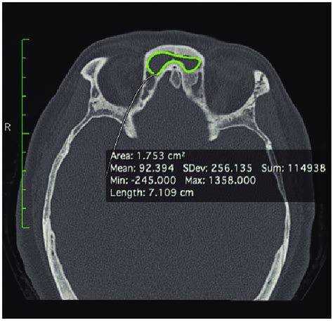 Contour Area Of FNO Year Postoperatively Green Circle Download Scientific Diagram