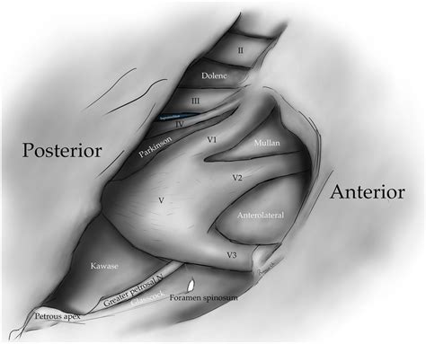 Supratrochlear Triangle Space Bordered Medially By The Oculomotor
