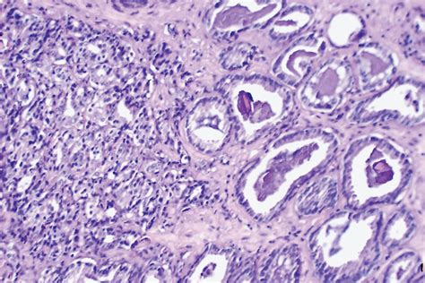 Prostate Cancer Cells