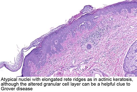 Pathology Outlines Transient Acantholytic Dermatosis