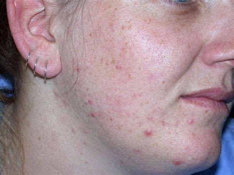 Blackhead Vs Pimple What S The Difference