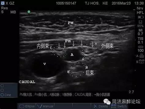 手把手教你“超声引导下臂丛神经阻滞”