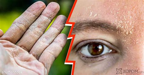 Хэрэв таны арьс хуурайшиж гyyжаад байвал дараах шалтгаантай холбоотой