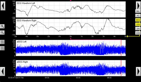 6 Secrets To Reading Your Aeeg