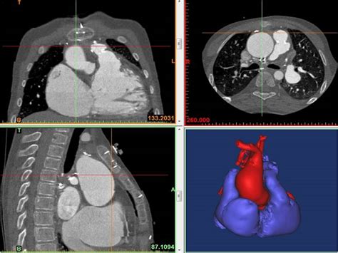 Pulmonary Artery Atresia With Ventricular Septal Defect And Mapcas 3d