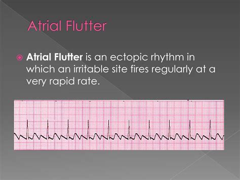Chapter 4 Atrial Rhythms Ppt Download