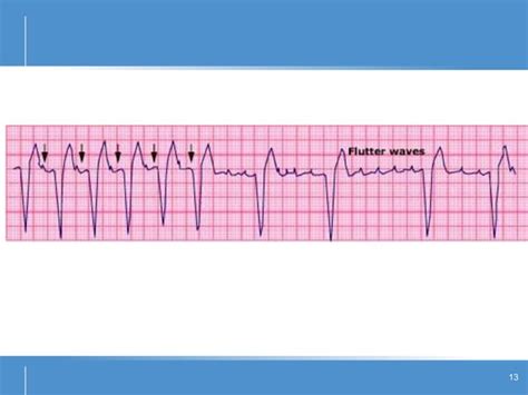 Atrial Flutter Afl Management Principals Pptx Ear Nose And