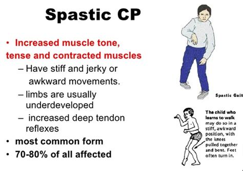 Spastic Cerebral Palsy Cause Symptoms Treatment Exercise
