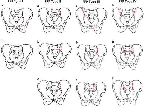 Types I Iv With Subtypes A B C Of Fragility Fractures Of The Pelvic
