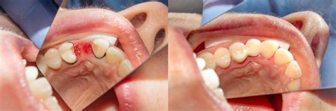 Tooth Extractions In Scottsdale Az Same Day Appointments Available