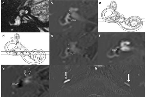 Illustrations Of The Mri Descriptors A T2 Space Axial Image Is Unable Download Scientific