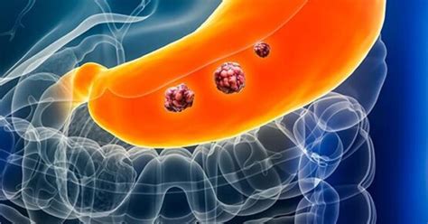 Votre Groupe Sanguin Pourrait Influencer Vos Risques De Cancer Gastrique Selon Des Scientifiques