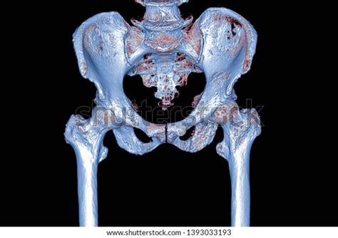 Ct Scan Pelvic Bone Both Hip Stock Illustration Shutterstock