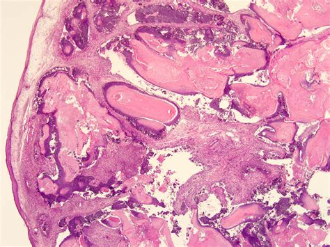 Pilomatricoma Histology