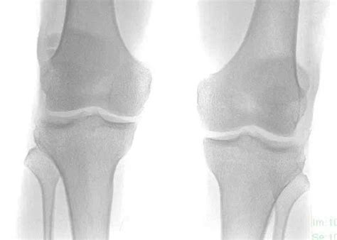 PHILIPS每日一例单侧二分髌骨 Bipartite patella X线病例图片影像诊断 MedSci cn