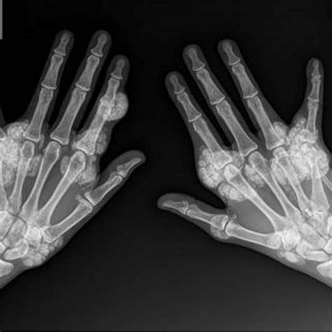 Panel A Nodules Predominantly Affecting The Metacarpophalangeal Download Scientific Diagram