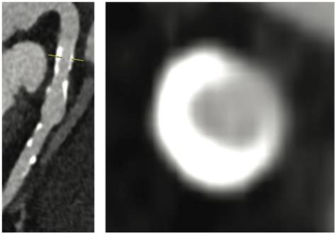 Removing Calcification Artifacts In Cad Cath Lab Digest