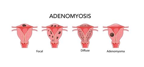Adenomyosis Adenomyosis Pregnancy Symptoms Diagnosis Treatment