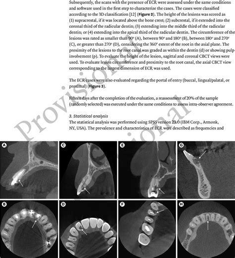 Examples Of External Cervical Resorption Indicated By White Arrows A Download Scientific