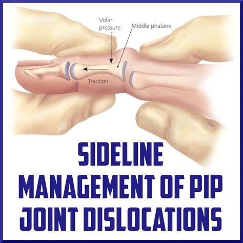 Sideline Management Of PIP Dislocation Sports Medicine Review