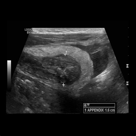 Ruptured Appendix Ultrasound