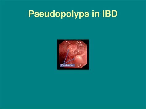 Ppt Colon Polyps Powerpoint Presentation Free Download Id 6619974