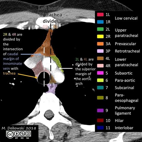 Subcarinal Lymph Node