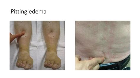 Approach To Pedal Edema For Undergraduates Pptx